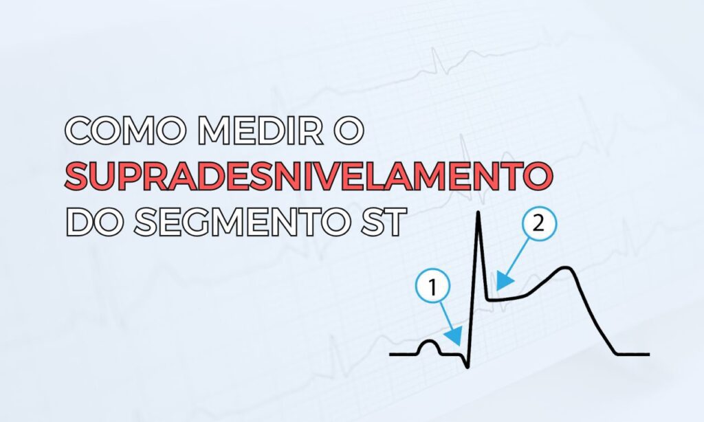 Como Medir o Supradesnivelamento do Segmento ST no ECG - Aprenda ECG