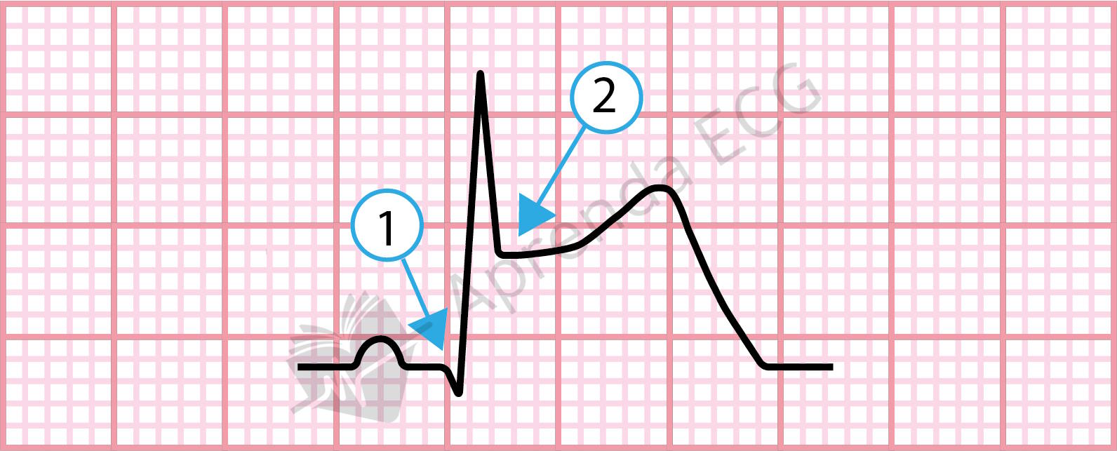 Tudo que Você Precisa Saber sobre o Supradesnivelamento do Segmento ST - Aprenda ECG