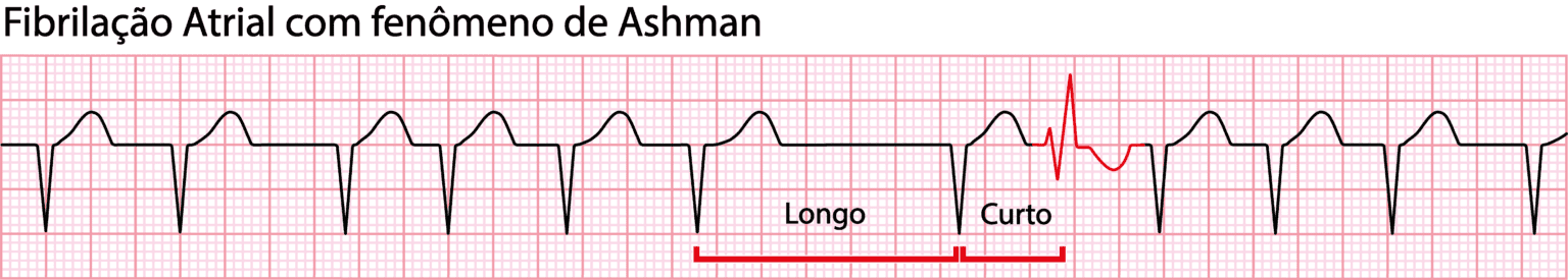 QRS largo na fibrilação atrial? Pode ser o fenômeno de Ashman - Aprenda ECG