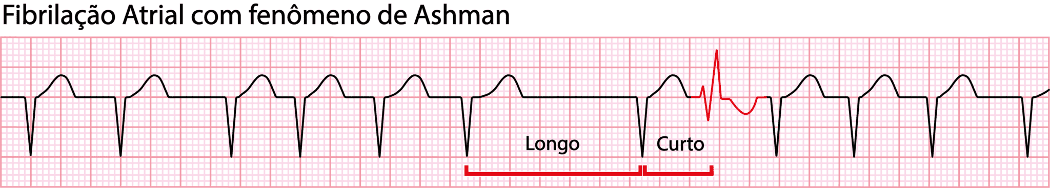 QRS largo na fibrilação atrial? Pode ser o fenômeno de Ashman - Aprenda ECG