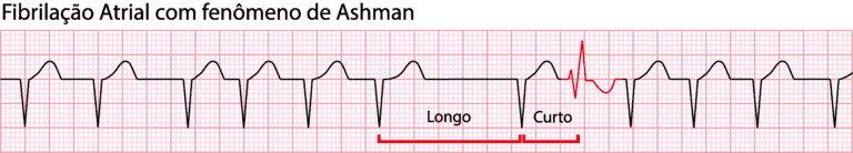 QRS largo na fibrilação atrial? Pode ser o fenômeno de Ashman - Aprenda ECG