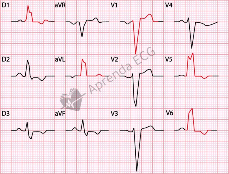 Bloqueio de Ramo Esquerdo: Critérios, Mecanismo e Implicações Clínicas ...