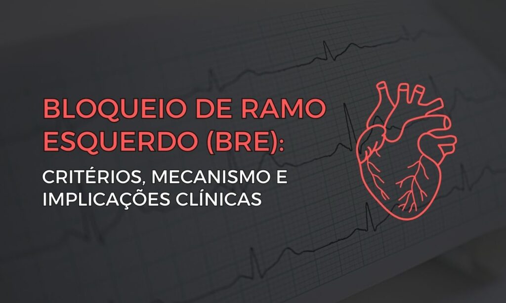 Como Reconhecer o Bloqueio de Ramo Direito no ECG - Aprenda ECG
