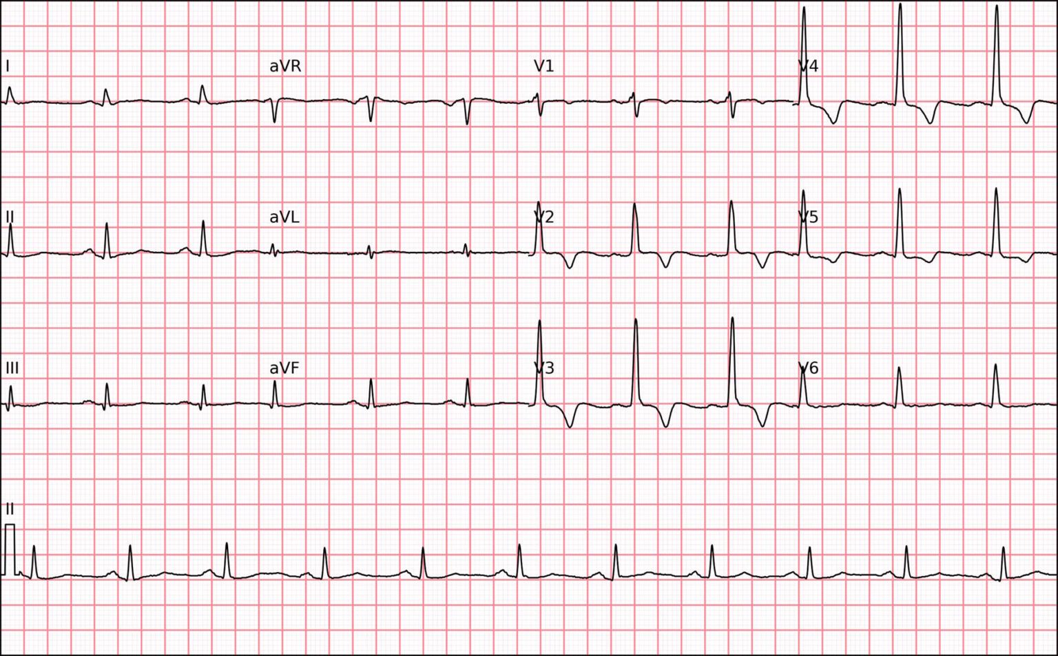 10 Causas de Onda R Alta em V1 e V2 - Aprenda ECG