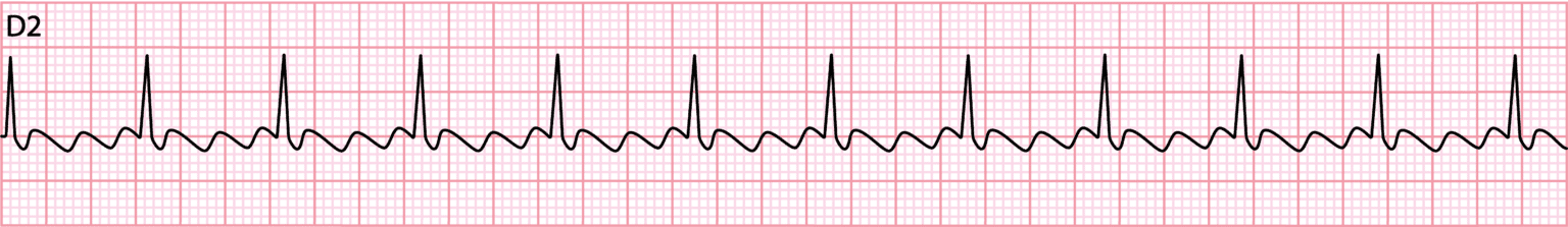 Flutter Atrial: guia completo para acadêmicos de medicina - Aprenda ECG