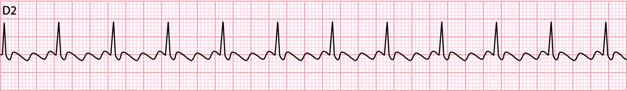 Flutter Atrial: guia completo para acadêmicos de medicina - Aprenda ECG