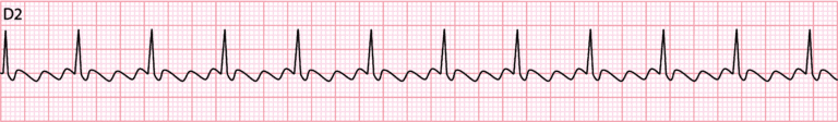 Flutter Atrial: guia completo para acadêmicos de medicina - Aprenda ECG