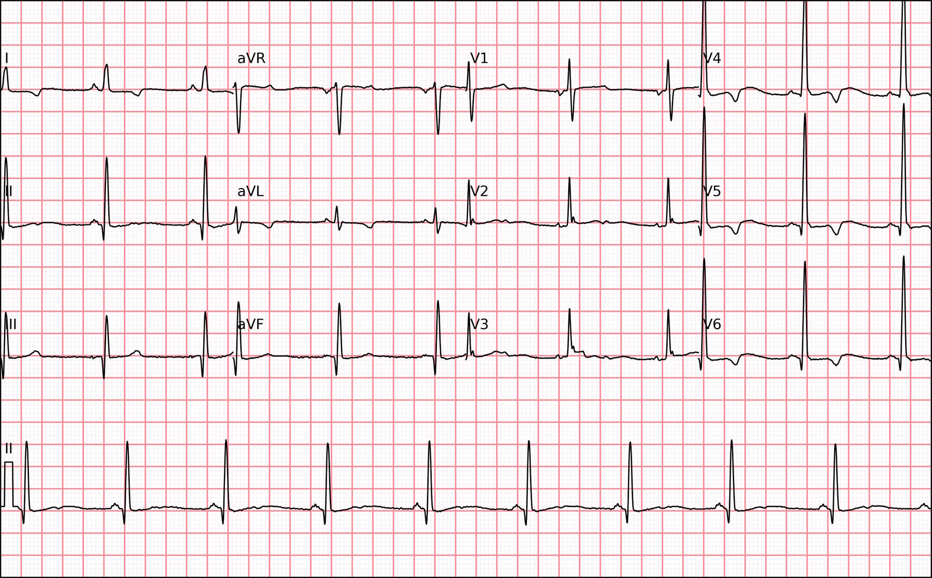 10 Causas de Onda R Alta em V1 e V2 - Aprenda ECG