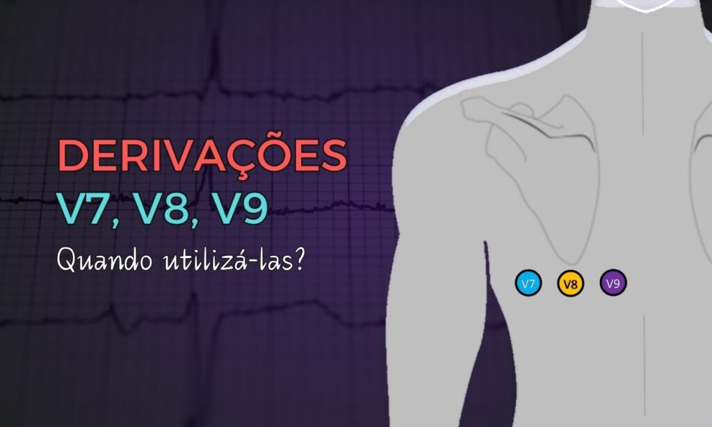 Derivações V7, V8 e V9: Quando utilizá-las? - Aprenda ECG