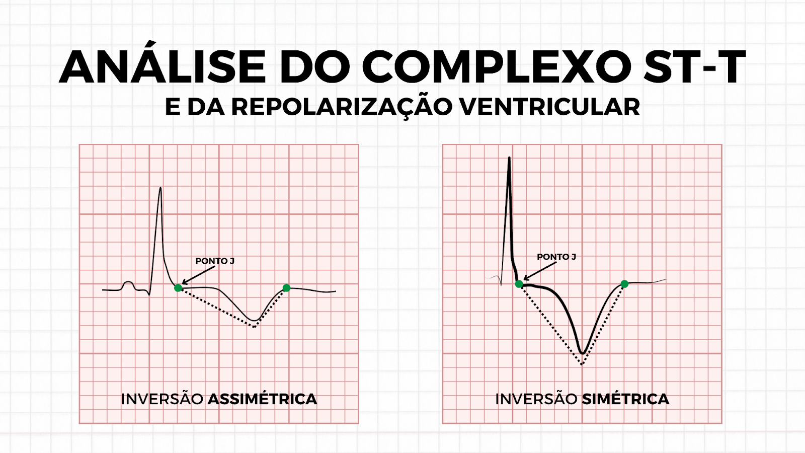 Repolarização Ventricular: Como interpretar o Complexo ST-T - Aprenda ECG