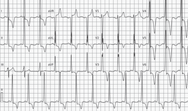 Repolarização Ventricular: Como interpretar o Complexo ST-T - Aprenda ECG